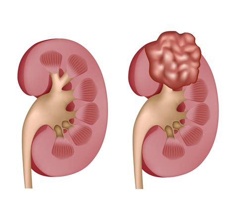 თირკმლის კიბო Mmt ჰოსპიტალი