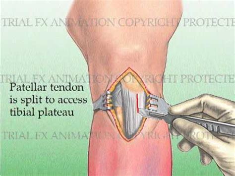 Intramedullary Rod Tibia