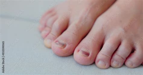 Subungual Hematoma On Toenail Are Injuries Of Wearing Shoes That Are