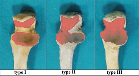 Morphology Of Ulnar Trochlear Notch And Defining Ideal Position For Olecranon Osteotomy