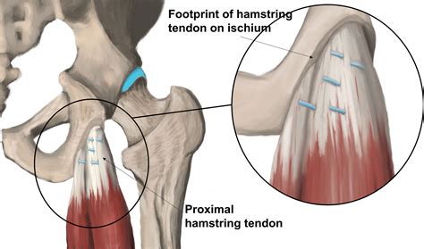 Fixation Of The Proximal Hamstring Tendon Using An All Suture