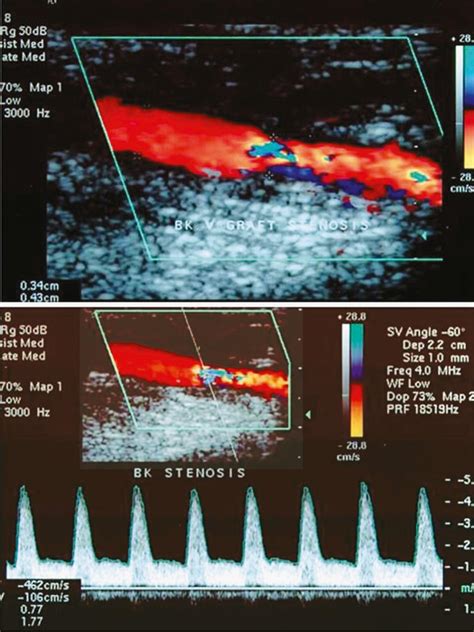 Vascular Laboratory Arterial Duplex Scanning Clinical Tree