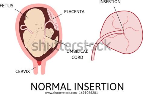 Normal Insertion Umbilical Cord Insertion Site Stock Vector Royalty