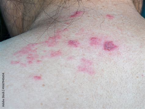 Shingles Herpes Zoster Shingles Is A Type Of Skin Disease This Is