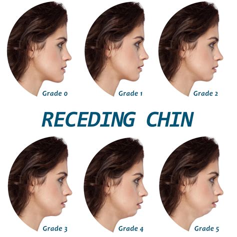 Receding Chin And Class Ii Malocclusion Surgical Before And After