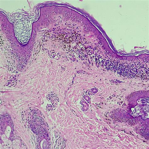 Vacuolar Degeneration Of The Basal Cell Layer Of Epidermis Band Like Download Scientific