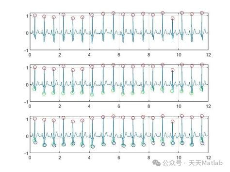 【心电信号】基于小波变换实现心电信号p q r s t波位置标记附matlab代码 matlab小波变换r波 csdn博客