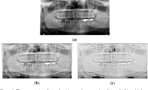 Figure 5 From Combined Deep Learning Techniques For Mandibular Fracture
