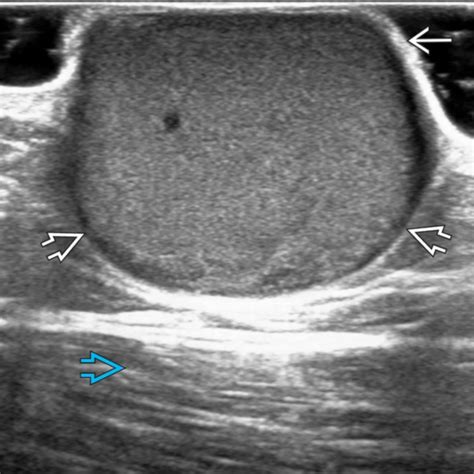 Epidermoid Cyst Ultrasound