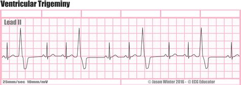 Ecg Educator Blog Ventricular Trigeminy
