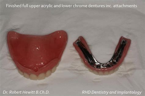 Denture Stabilization Case Rh Dental