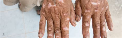 Scleroderma And Lupus Kaleidoscope Fighting Lupus