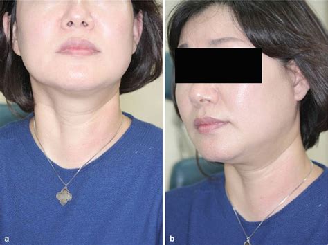 Robot Assisted Neck Dissection In Papillary Thyroid Carcinoma