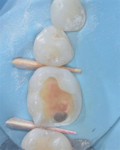 What Is C Factor — Alleman Center Of Biomimetic Dentistry