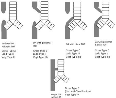 Newly Discovered Variant Of Oesophageal Atresia ‘type Y Bmj Case Reports