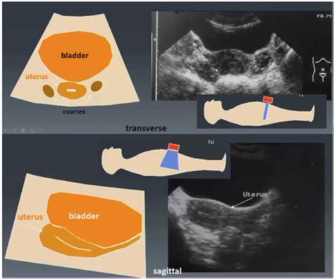 Retroverted Uterus Transabdominal Ultrasound General Techniques In