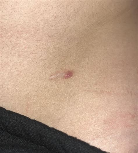 Pailful And Infected Appendectomy Scar R Dermatologyquestions