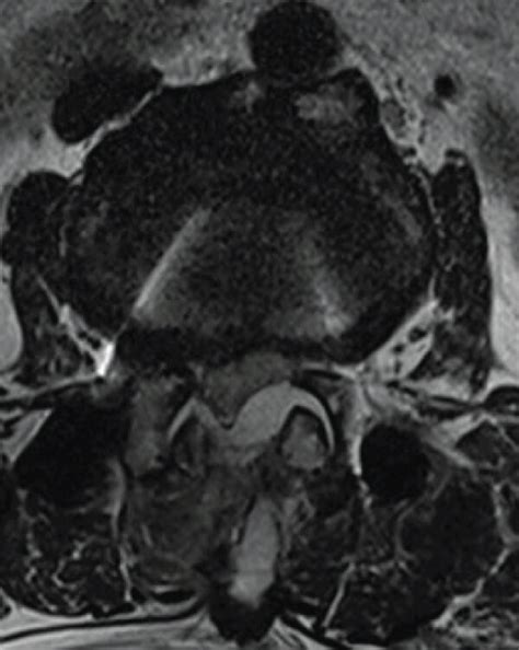 A Patient Who Underwent Bess Decompression For L23 Spinal Stenosis A