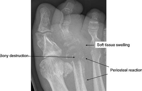 Beginning Arthritis Foot X Ray