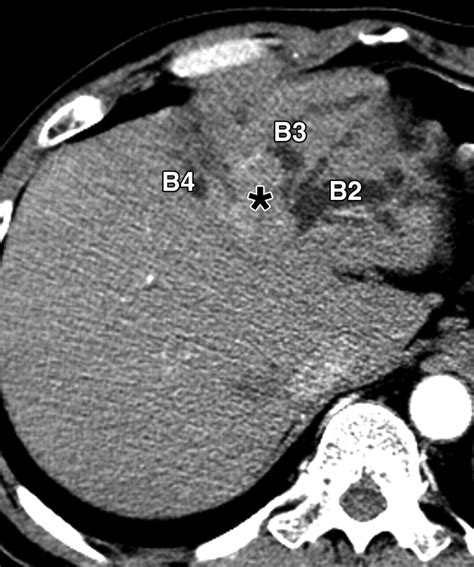Differential Ct Features Of Intraductal Biliary Metastasis And Double Primary Intraductal