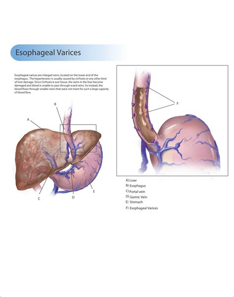 Esophageal Varices On Behance