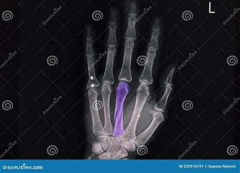 Fractured Third Metacarpal Bone Stock Image Image Of Joint Medicine