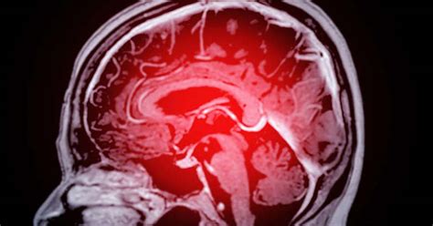 Frontotemporal Dementia Types Symptoms Causes And More