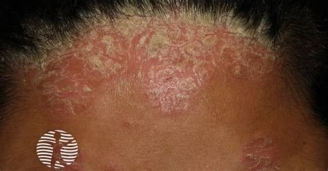 Psoriasis Of The Scalp Image
