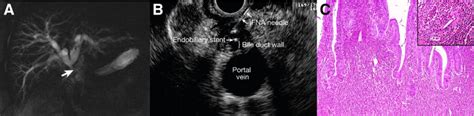 Eosinophilic Cholangitis Clinical Gastroenterology And Hepatology