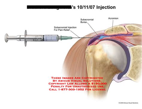 Amicus Illustration Of Amicussurgeryinjectionrotatorcufftear