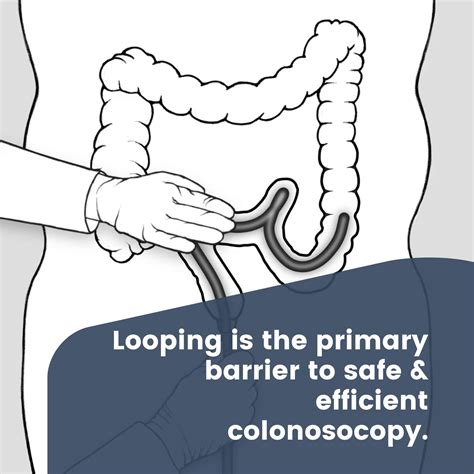 Looping During Colonoscopy Remains The Biggest Barrier For Safe And