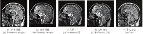 科学网基于自适应分数阶的医学图像非刚性配准 欧彦的博文