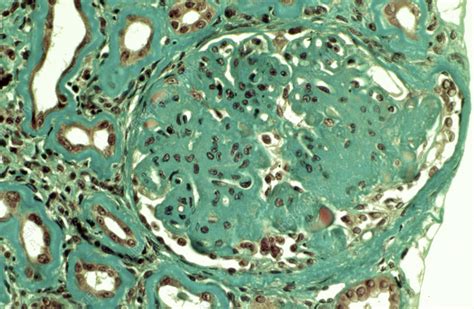 Nodular Glomerulosclerosis In Diabetes Light Micrograph Stock Image C061 2147 Science