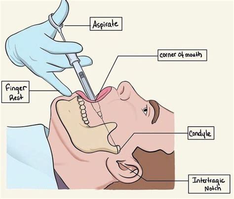 Gow Gates Technique For Mandibular Nerve Block Medizzy