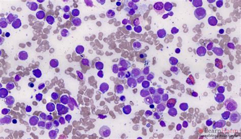 Aml M2 Acute Myeloid Leukemia With Maturation Learnhaem