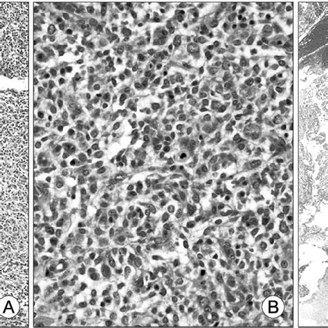 A Extrauterine Mesenteric Tumor Nodules Show Diffuse Proliferation