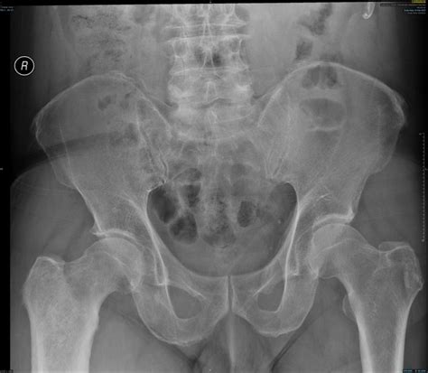 Vivek Ajit Singh On Linkedin 67 Years Old With Right Proximal Femur Chondrosarcoma Underwent Wide…