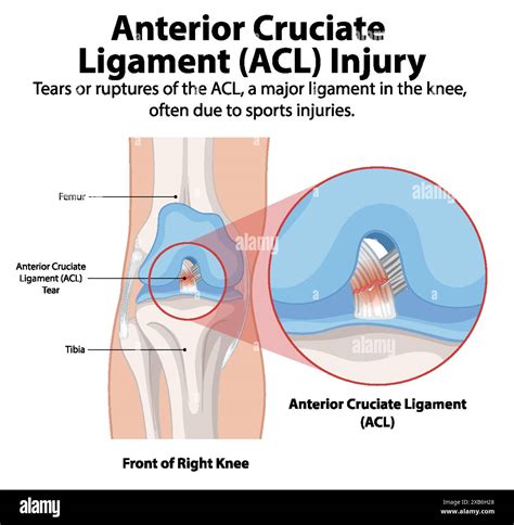 Illustration Of Acl Tear In The Knee Stock Vector Image And Art Alamy