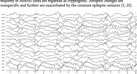 The Same Patient Continuation Of Ictal Eeg Eeg Reveals Combination Of Download Scientific