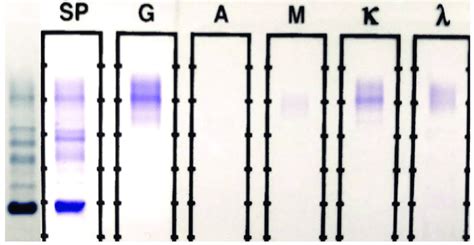 Spep And Sife In April 2017 The Original Malignant Igg Kappa Clone Is