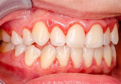 Gingivitis Causes Risks And Treatments