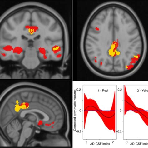 Curve Clustering Algorithm Run On Relevant Atrophy Patterns Along The