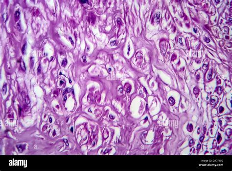 Uterine Fibroid Light Micrograph Lm Of A Section Through Tissue From