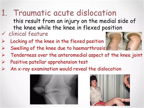 Patella And Tibial Plateau Fractures Pptx