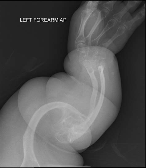 Osteogenesis Imperfecta Understanding Type Ii Overview