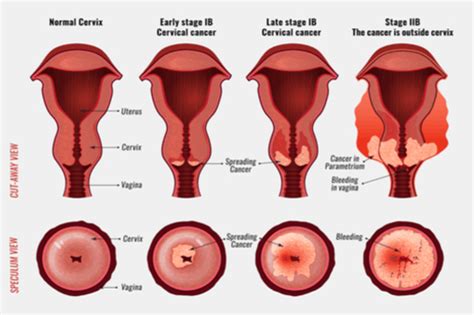 Std Vaginal Bleeding