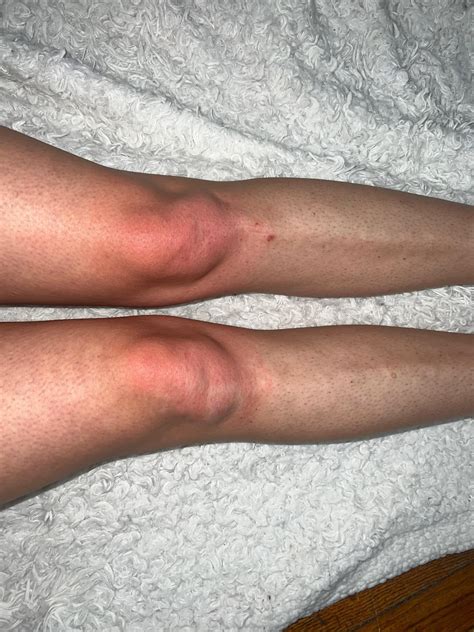 Red Kneesfeet With Some Swelling Pictures Rpsoriaticarthritis