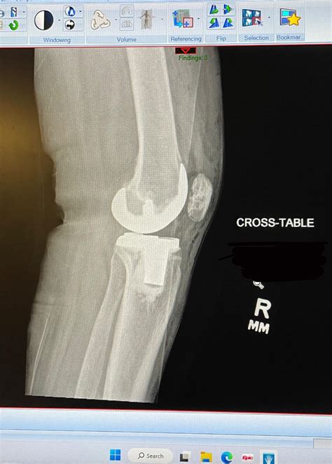 Cross Table Lateral X Ray