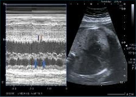 Case 3 Fetal Echocardiogram Detailing The Fetal Supraventricular