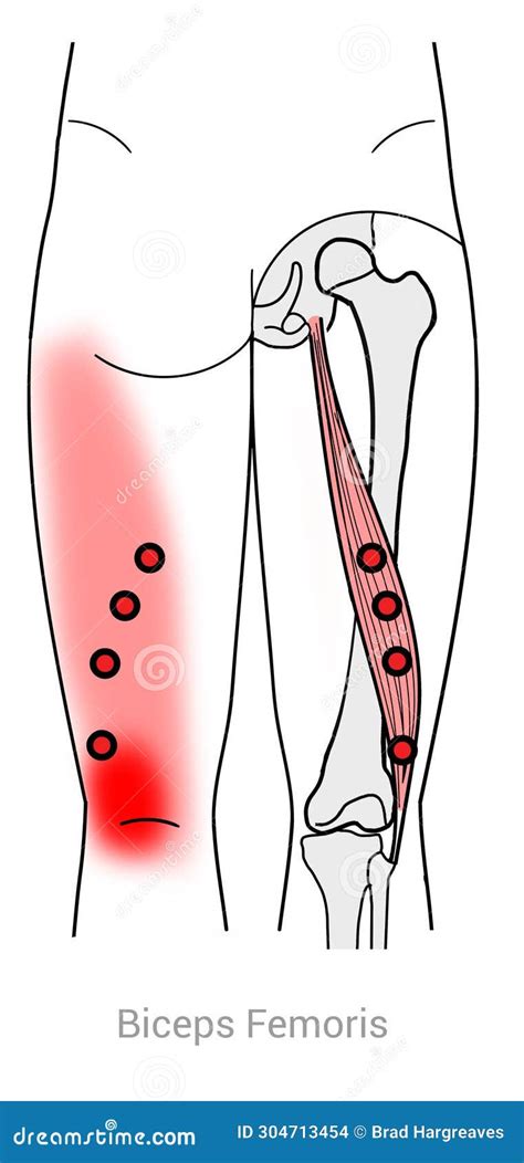 Biceps Femoris Trigger Points May Cause Upper Thigh And Knee Pain Stock Illustration